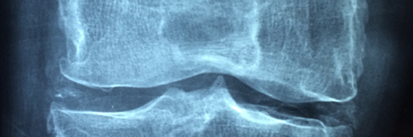 Laminectomy at Mount Elizabeth Medical Centre, Singapore